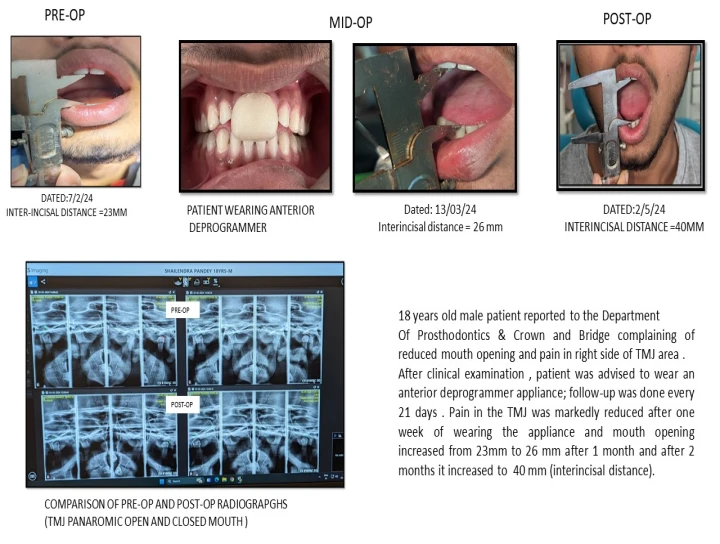 Management of a TMD patient by Occlusal Splint Therapy|SDCINDIA Management of a TMD patient by Occlusal Splint Therapy|SDCINDIA